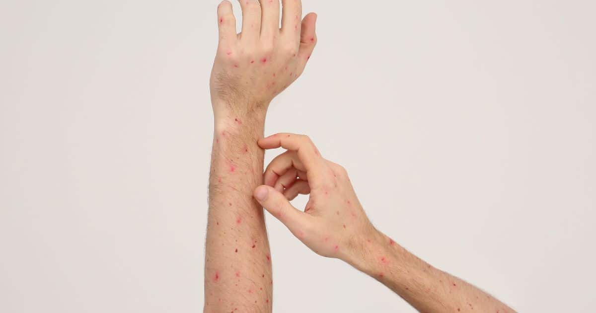 What are Meth Mites & How Do You Deal With Them?