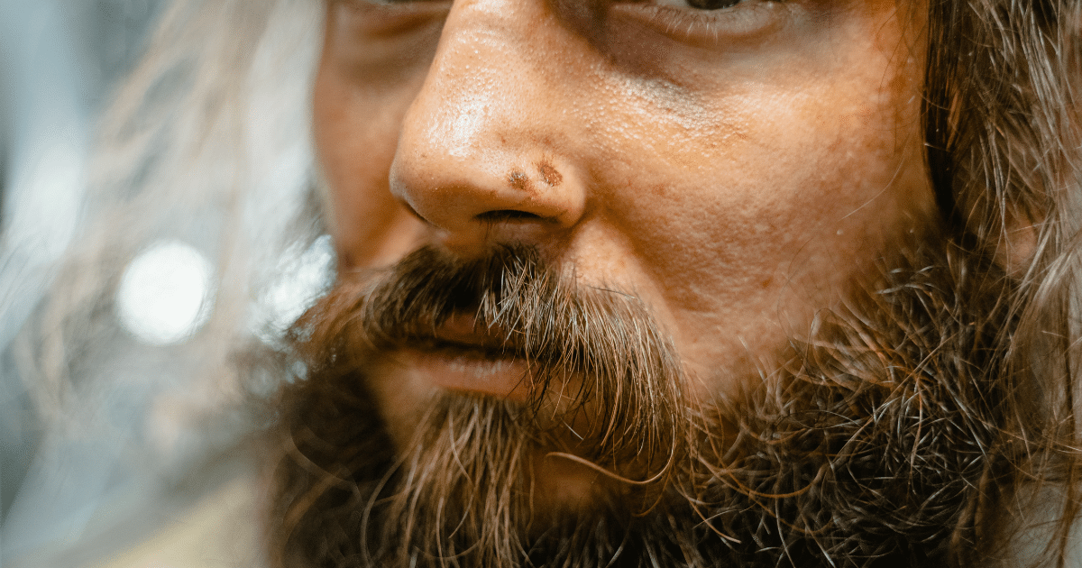 Alcoholic Nose: Signs, Symptoms, and Treatment